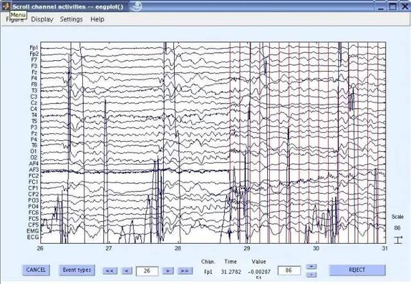 同步脑电-功能磁共振（EEG-FMRI）伪影去除方法及工具箱介绍 - 知乎