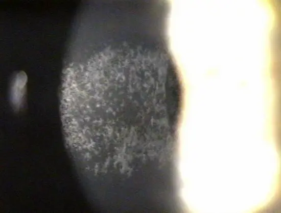 表层角膜激光术后haze的成因与治疗 - 知乎