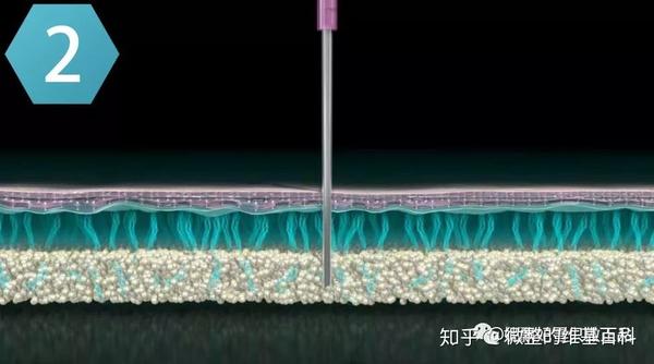 今天我们来聊聊线雕吧，你们只知道PDO/PPDO和PLA以及PLLA吗？史上最全线雕科普包含铃铛线 - 知乎