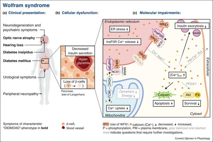 wolfram综合征（单基因糖尿病的魔怔） - 知乎
