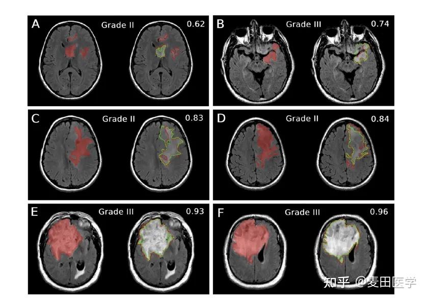 文献速递：深度学习胶质瘤诊断---使用深度学习在 MRI 图像中进行低级别胶质瘤的脑肿瘤分割和分级 - 知乎