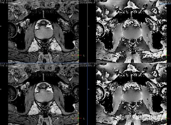 SWI序列原理及临床应用 - 知乎