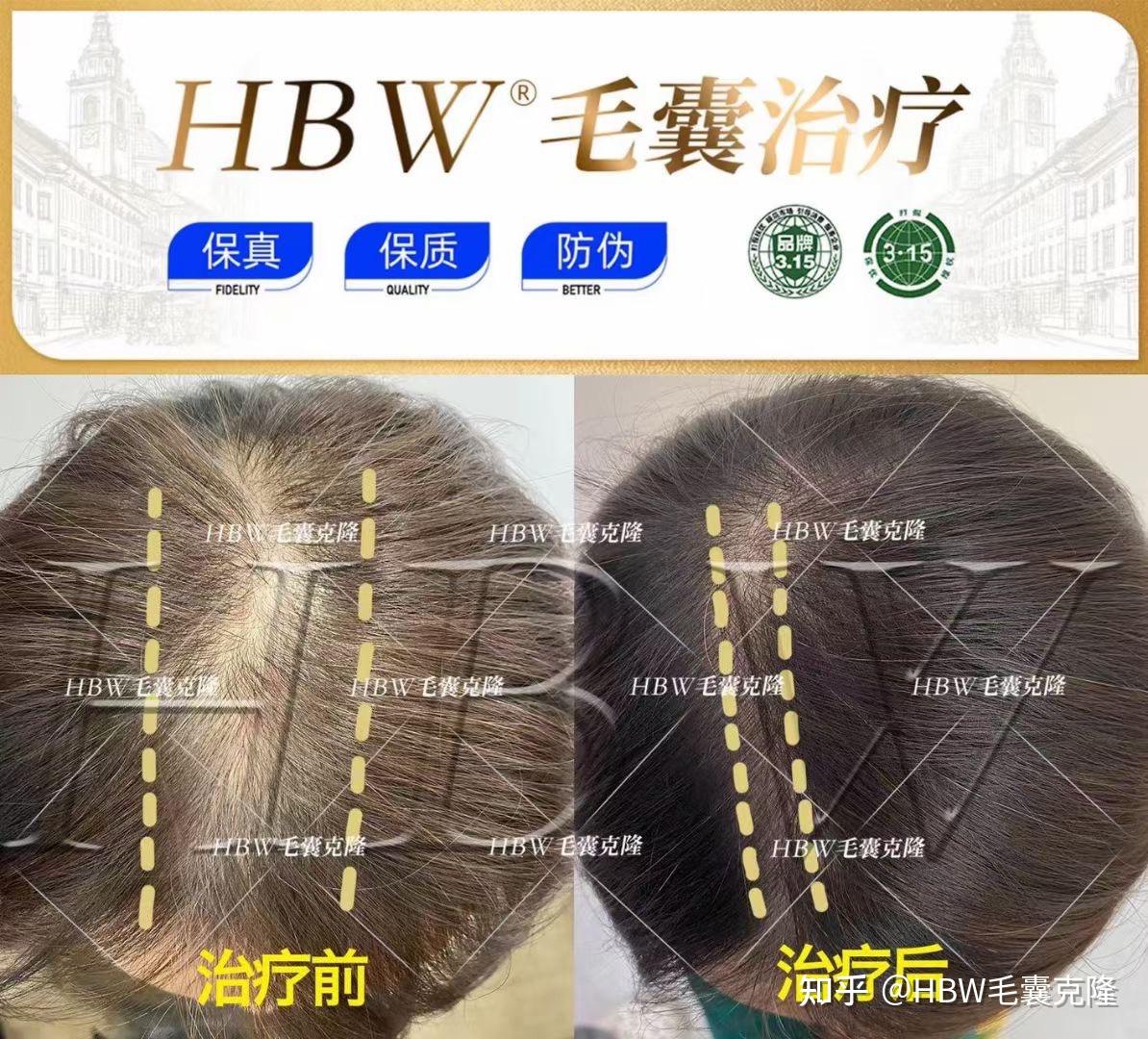 毛囊治疗HBW - 知乎