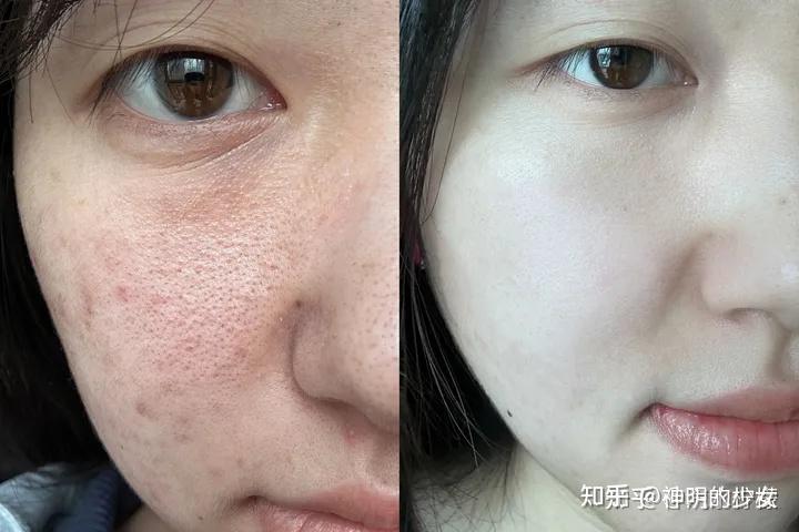 脸上出油严重，被撑开的大毛孔该怎么安全的变细致？ 知乎
