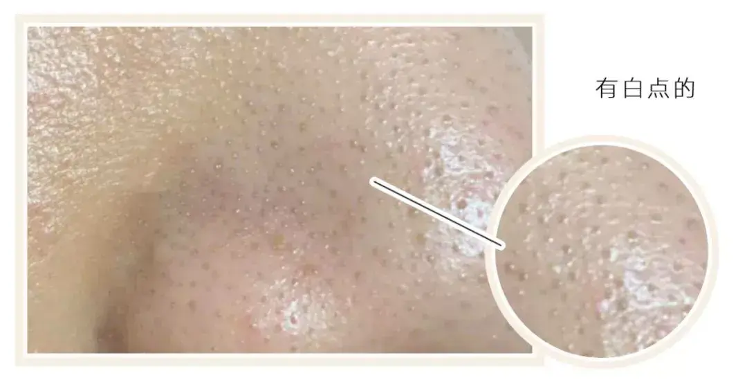 非黑即白的烦恼，这个让所有人发狂的肌肤问题，你遇到了吗？ 知乎