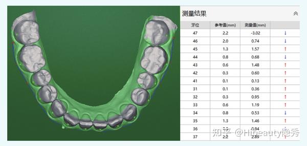 Hibeauty隐秀「上下牙拥挤/下牙列间隙/前牙反牙合 /拔除第三磨牙矫治」案例分享 知乎