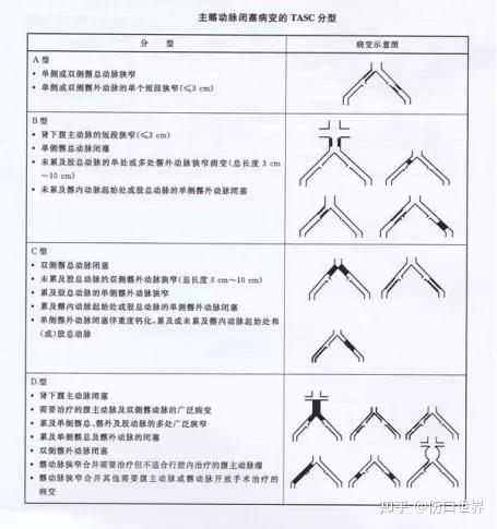 浅谈下肢动脉硬化闭塞症 - 知乎