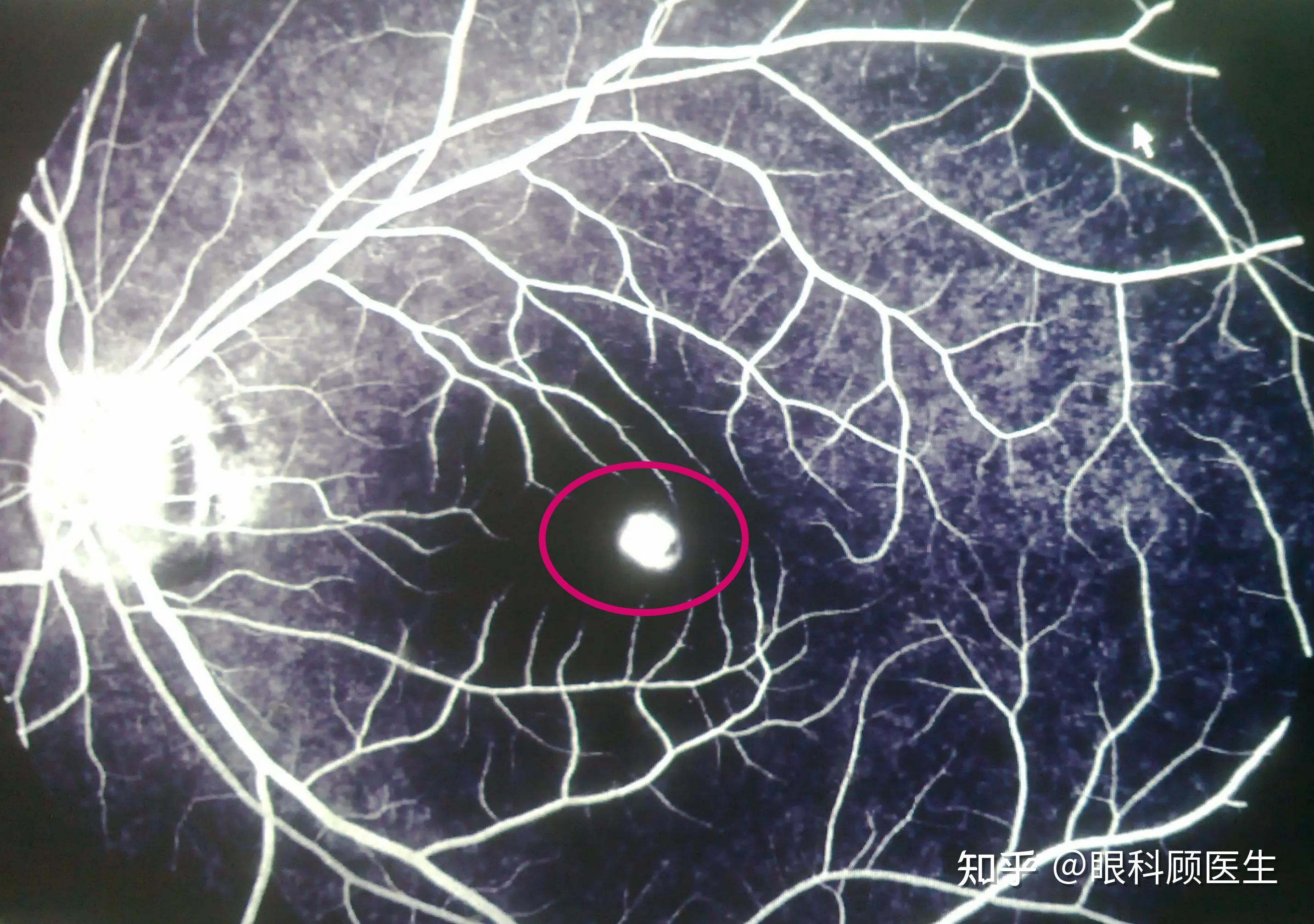 怎么判断和治疗中渗病？ - 知乎