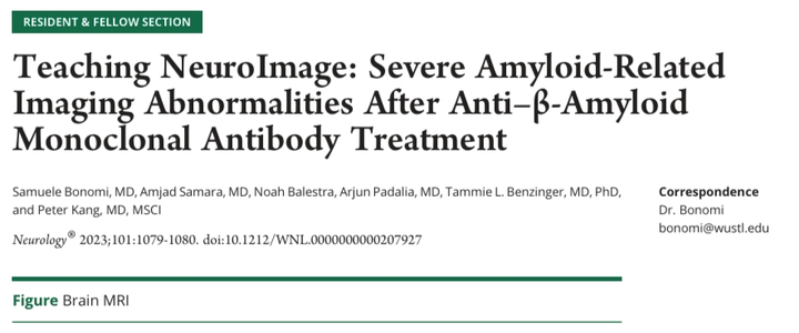 一例抗Aβ单抗Remternetug治疗三周后，引起严重的ARIA-E - 知乎