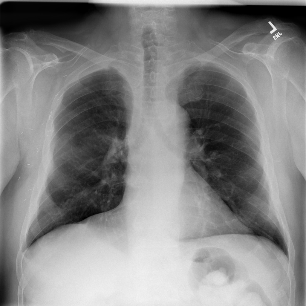 Chest X-ray PD Dataset 数据集介绍 - 知乎