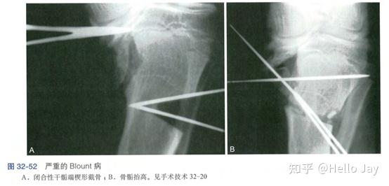 胫骨内翻（Blount病） - 知乎