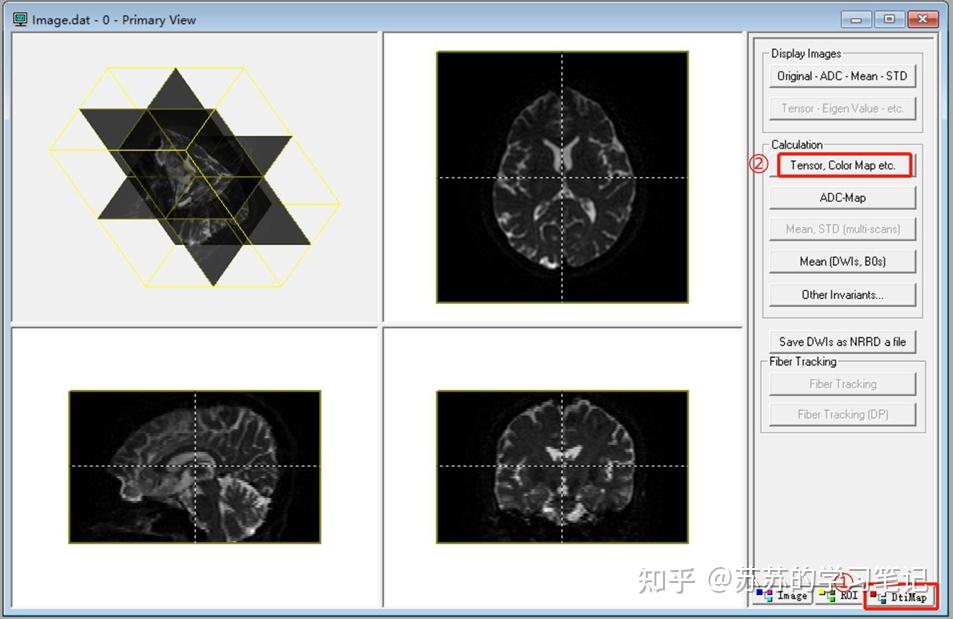 Diffusion spectrum imaging (DSI) 扩散光谱成像 与 Diffision tensor imaging （DTI ...