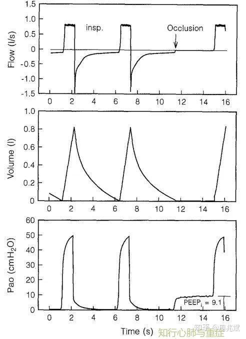 内源性呼气末正压（PEEPi）的发生机制、评估及处理[第110期] - 知乎