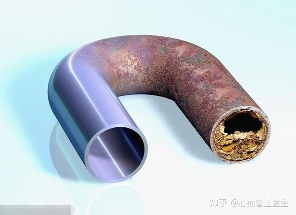 怎样逆转血管斑块 知乎