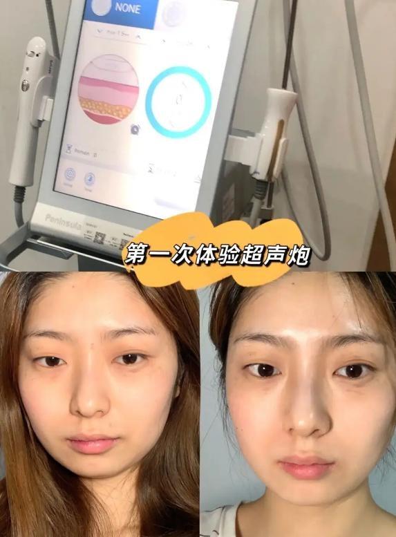超声炮效果怎么样,做完没效果什么原因 知乎