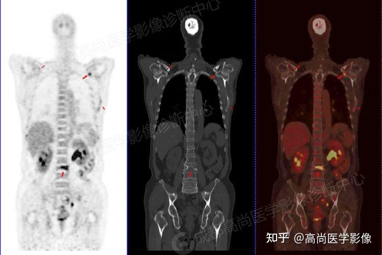 多发性骨髓瘤PET/CT诊断及疗效评估 - 知乎