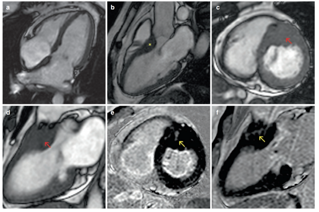 心脏磁共振典型病例集锦 - 知乎