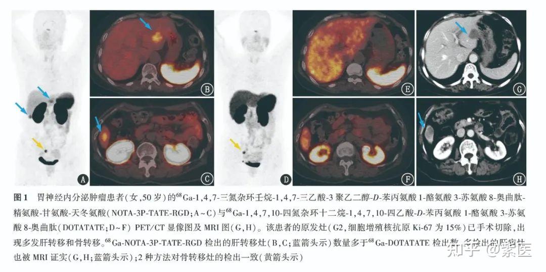 68Ga-NOTA-3P-TATE-RGD PET/CT在神经内分泌肿瘤中的应用 - 知乎