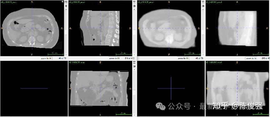 SynthRAD2025——用于放射治疗的计算机断层扫描生成挑战赛 - 知乎