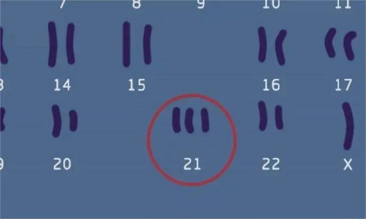 Nat Genet|解开唐氏综合征之谜：干扰素受体基因剂量的关键角色和治疗前景 - 知乎