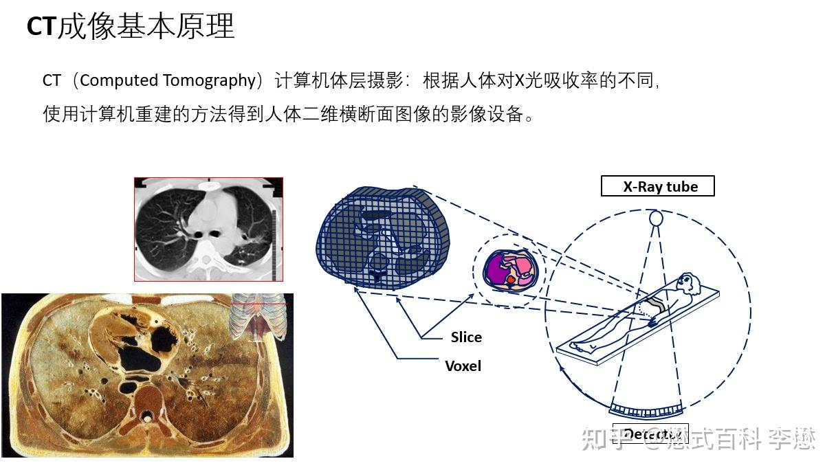 CT扫描为什么高密度呈现白色？ - 知乎