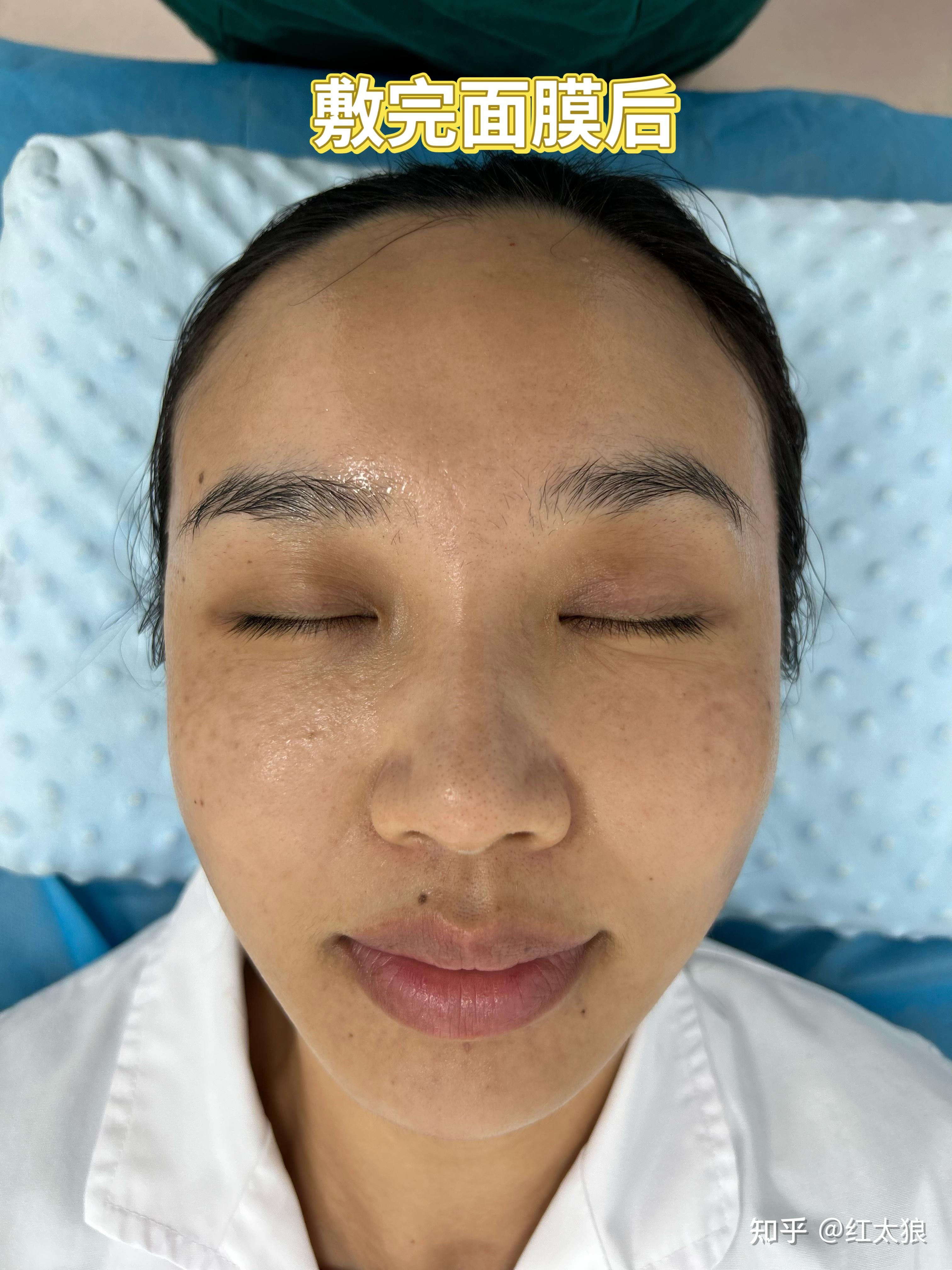 晒后修复日记（注射CGF） - 知乎