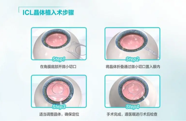 6步了解ICL晶体植入手术全过程 - 知乎