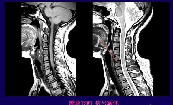 神内临床笔记53 颈椎病影像学表现 - 知乎