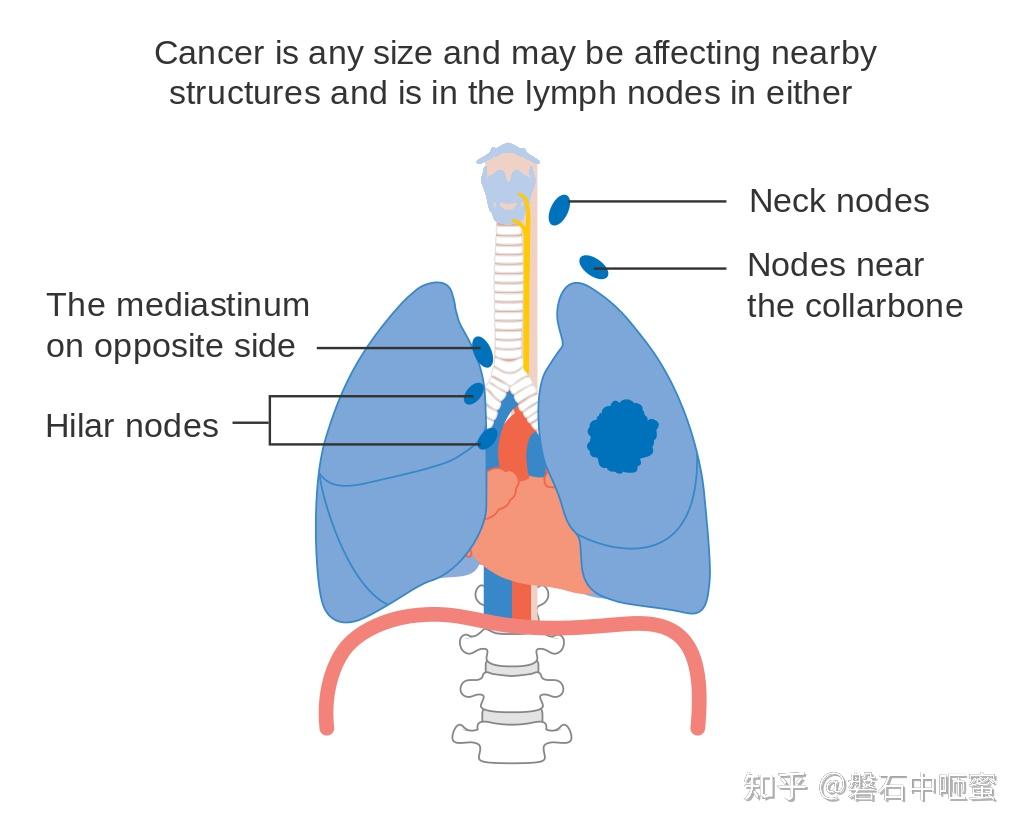 肺癌 Lung cancer - 知乎