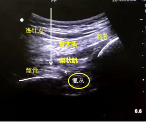 余斌教授：高危髋部骨折单肢神经阻滞麻醉镇痛技术及术前评估 - 知乎