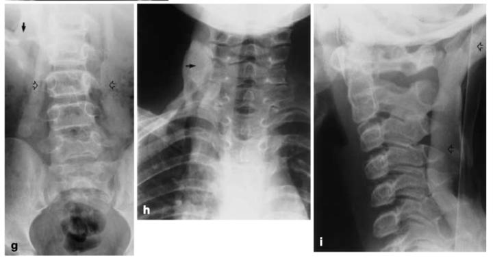FOP-进行性骨化性纤维发育不良 - 知乎