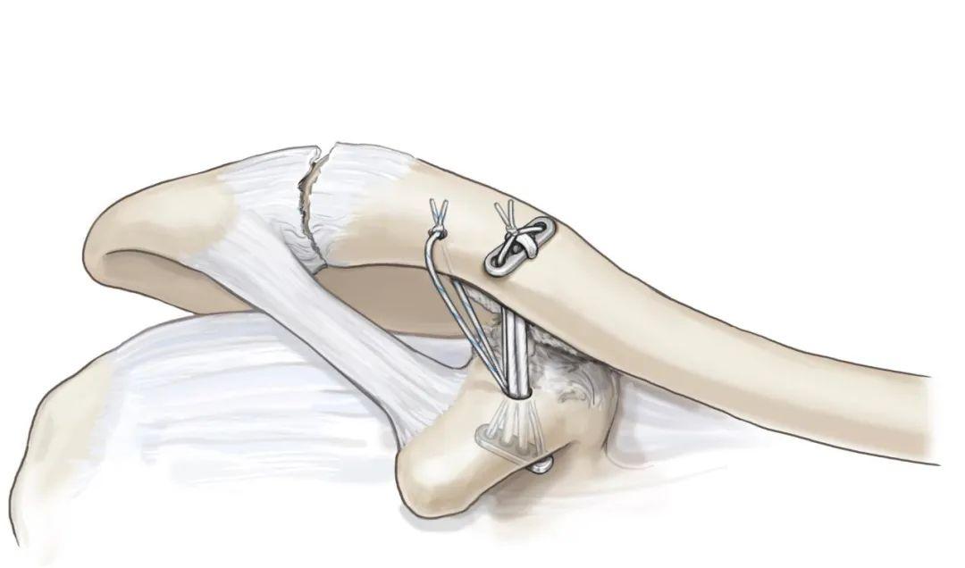 肩锁关节韧带损伤怎么恢复？ - 知乎