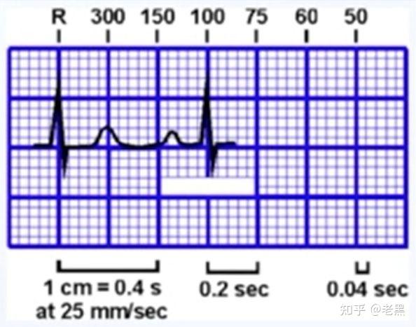 如何读懂ECG心电图 - 知乎
