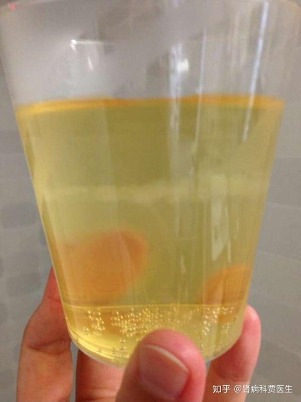 尿液是红色?别慌,这样做一定是对的! 知乎