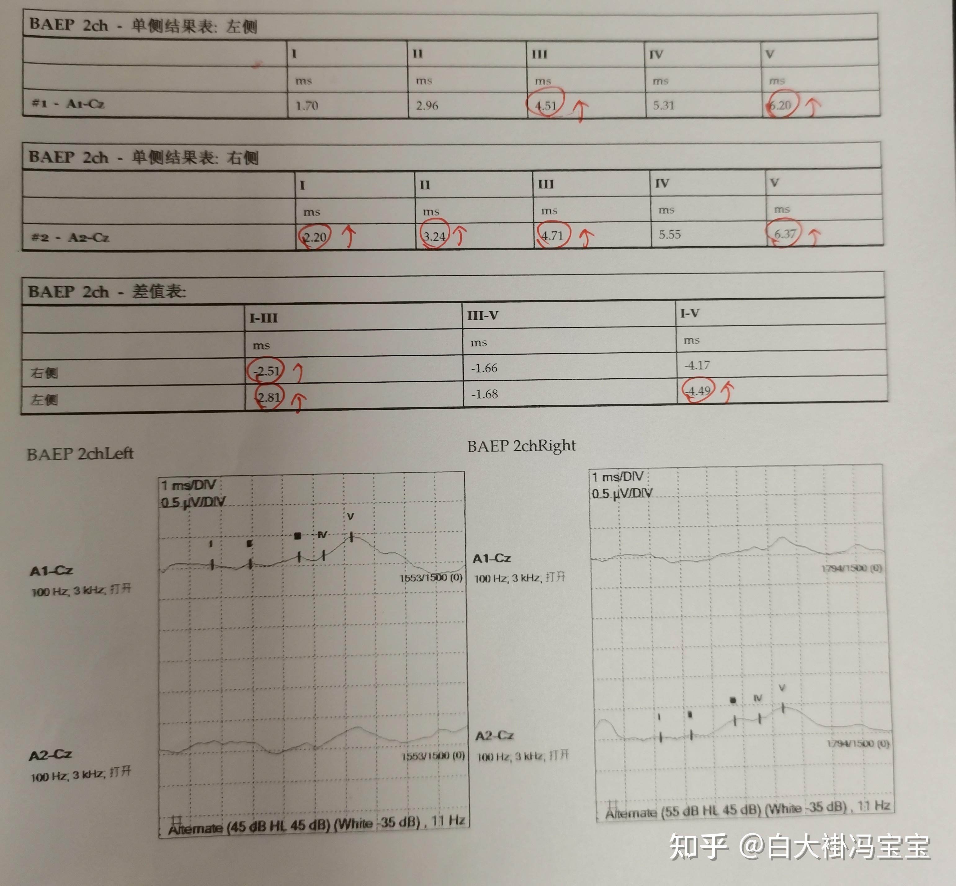 读懂“听觉脑干诱发电位（BAEP）报告”，看这篇就够了！ - 知乎