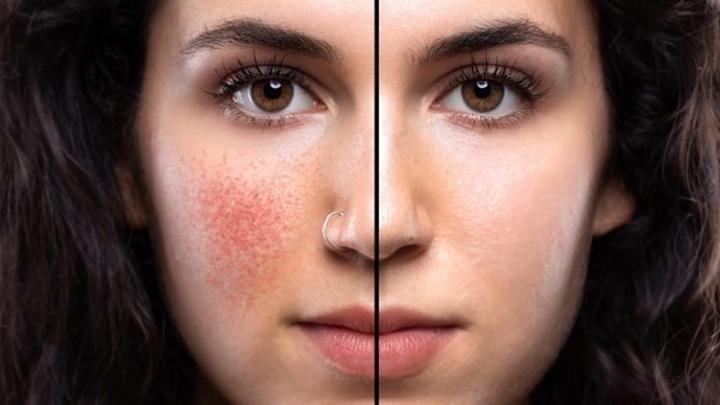 药剂师学习笔记之玫瑰痤疮（Acne Rosacea） - 知乎