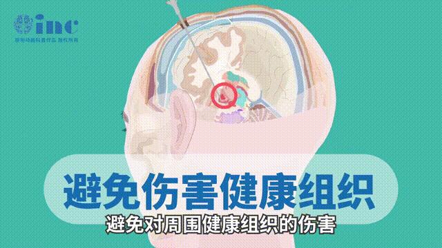 儿童癫痫＆脑瘤治疗新选择：INC（爱恩希）Rutka教授LITT治疗技术真实案例分享！ - 知乎