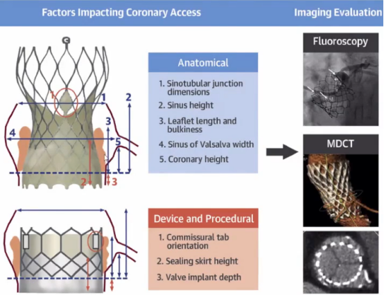 李捷教授：TAVR术后近远期冠脉介入的思考 - 知乎