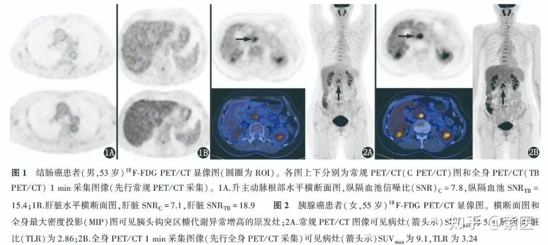 全身PET/CT 1 min采集图像与常规PET/CT图像质量比较：自身对照研究 - 知乎