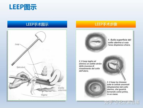 浅谈LEEP工作原理和应用 - 知乎