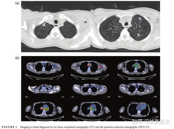 ROS1融合肺癌用恩曲替尼为何快速耐药？原来TP53突变在捣鬼 - 知乎