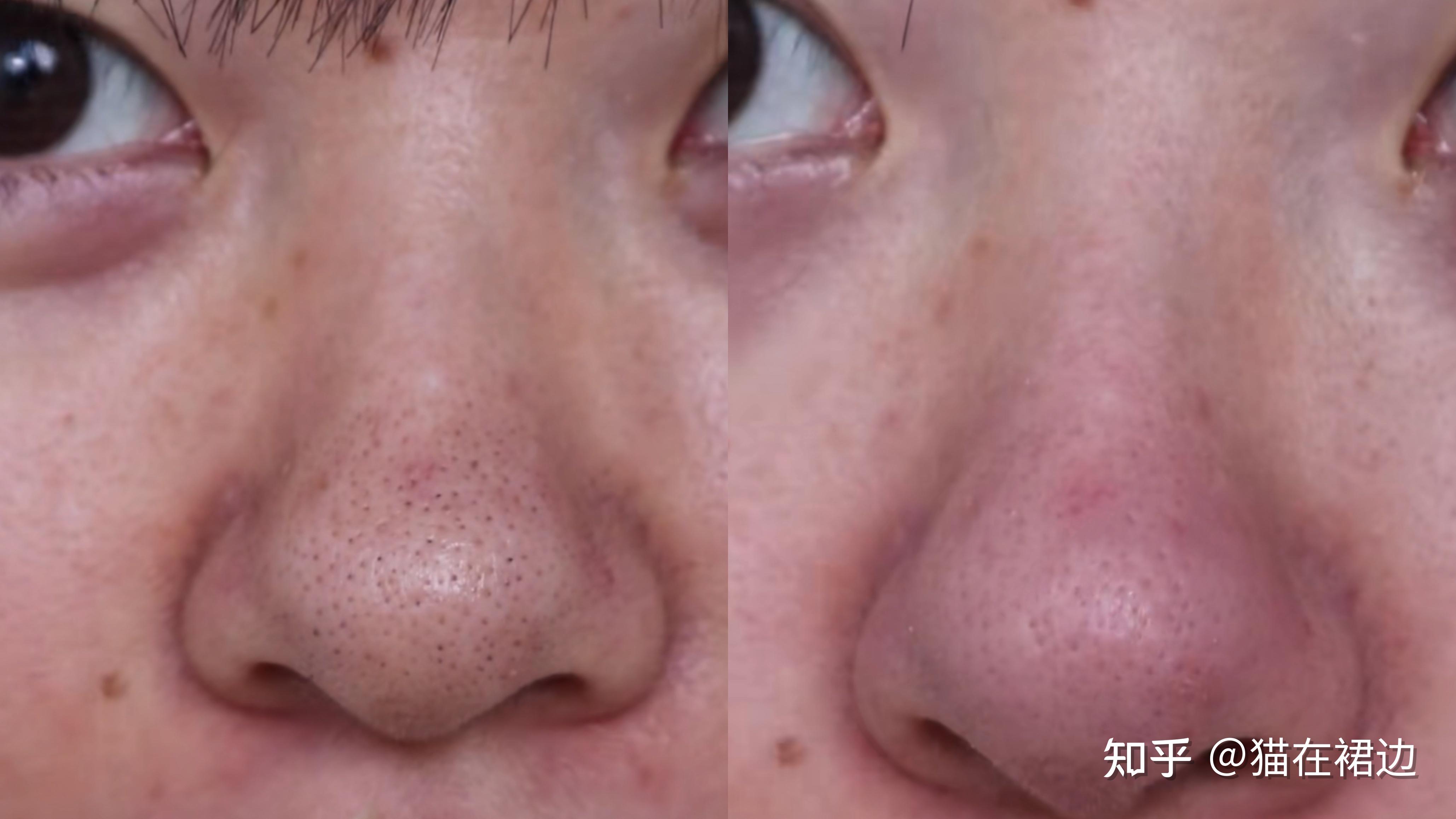 亲手把黑头一粒一粒揉出来是怎样的体验？ 知乎