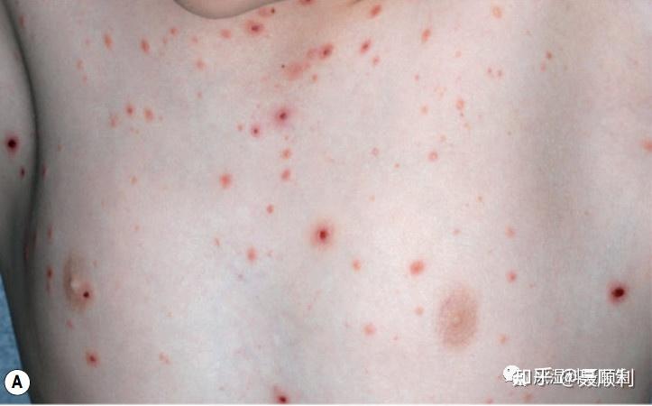 易跟过敏性紫癜混淆的疾病有哪些？（完结篇） - 知乎