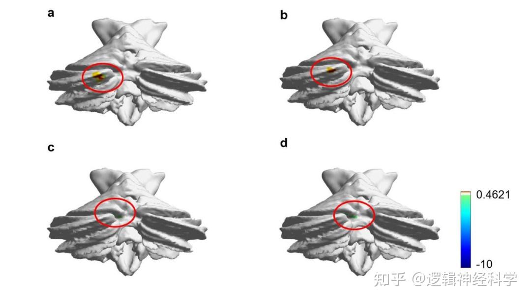 J Neurol︱特发性震颤患者脑微结构改变及其与临床特征的相关性：一项弥散峰度成像研究 - 知乎