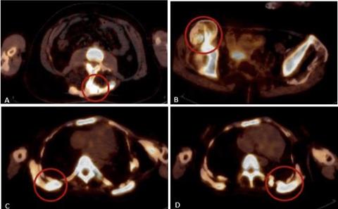 TMM of FOP-III. FOP的临床与基础科学背景-3.4 FOP的放射学特征 - 知乎