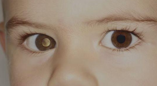 什么是PHPV眼病？能治好吗？ - 知乎