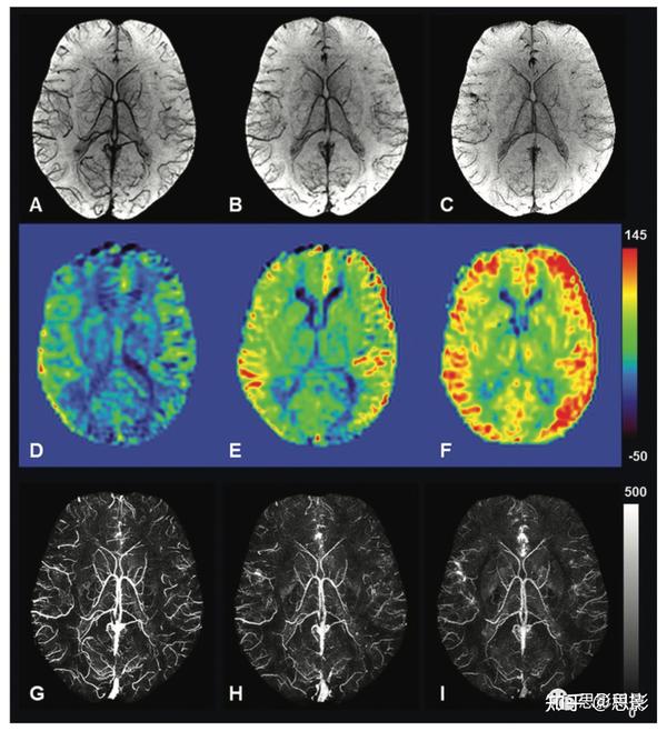 磁敏感加权成像（SWI)：技术要点和临床神经学应用 - 知乎