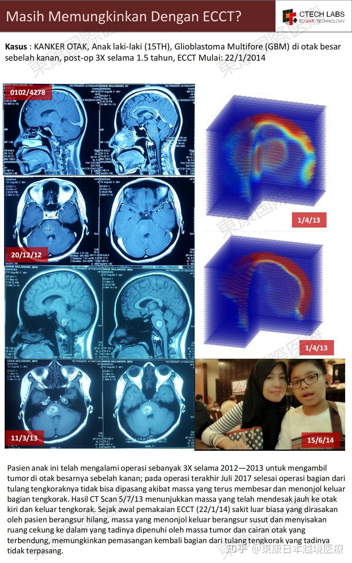 癌症治疗新利器ECCT电场治疗 - 知乎