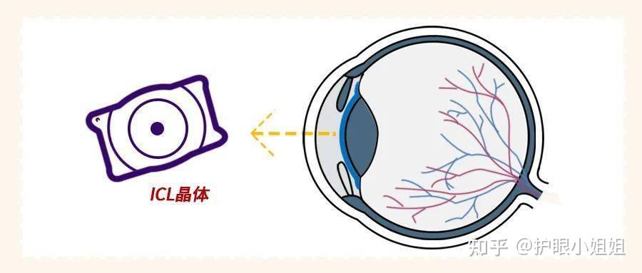 ICL术后效果可以维持多久？ - 知乎