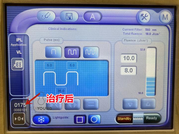 150+全光斑才是全脸全模式的M22超光子嫩肤 - 知乎